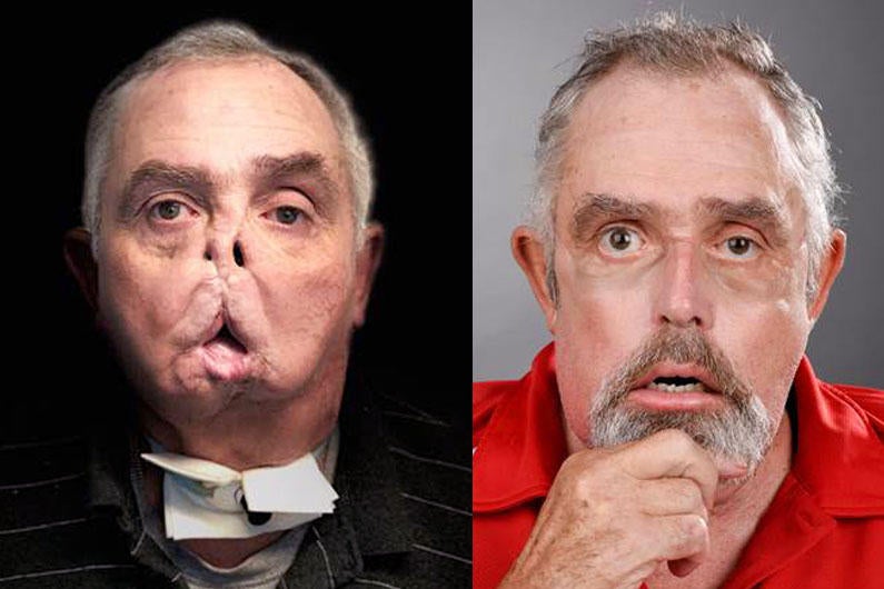 Amazing face transplants (GRAPHIC IMAGES)