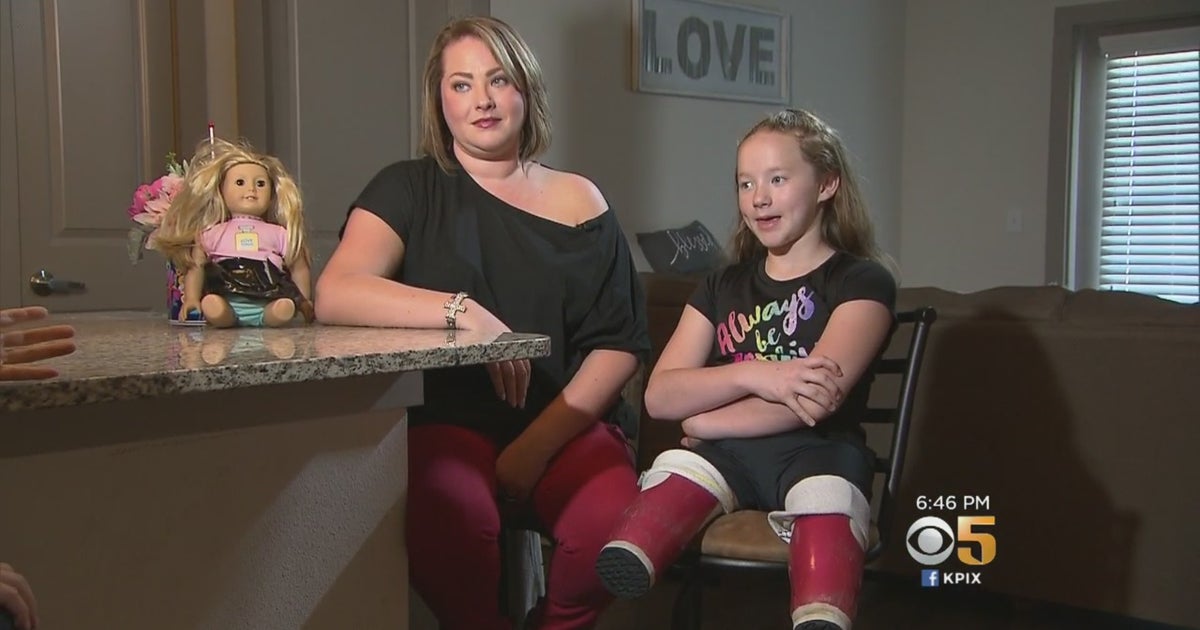 Resilient Girl Who Lost Prosthetic Legs In Tubbs Fire Starts Anew In ...