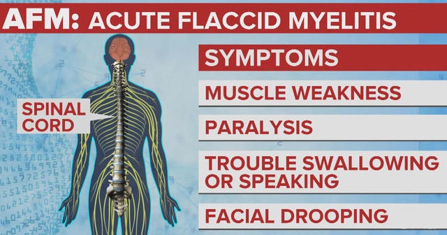 Mysterious polio-like illness impacting children in the U.S. - CBS News