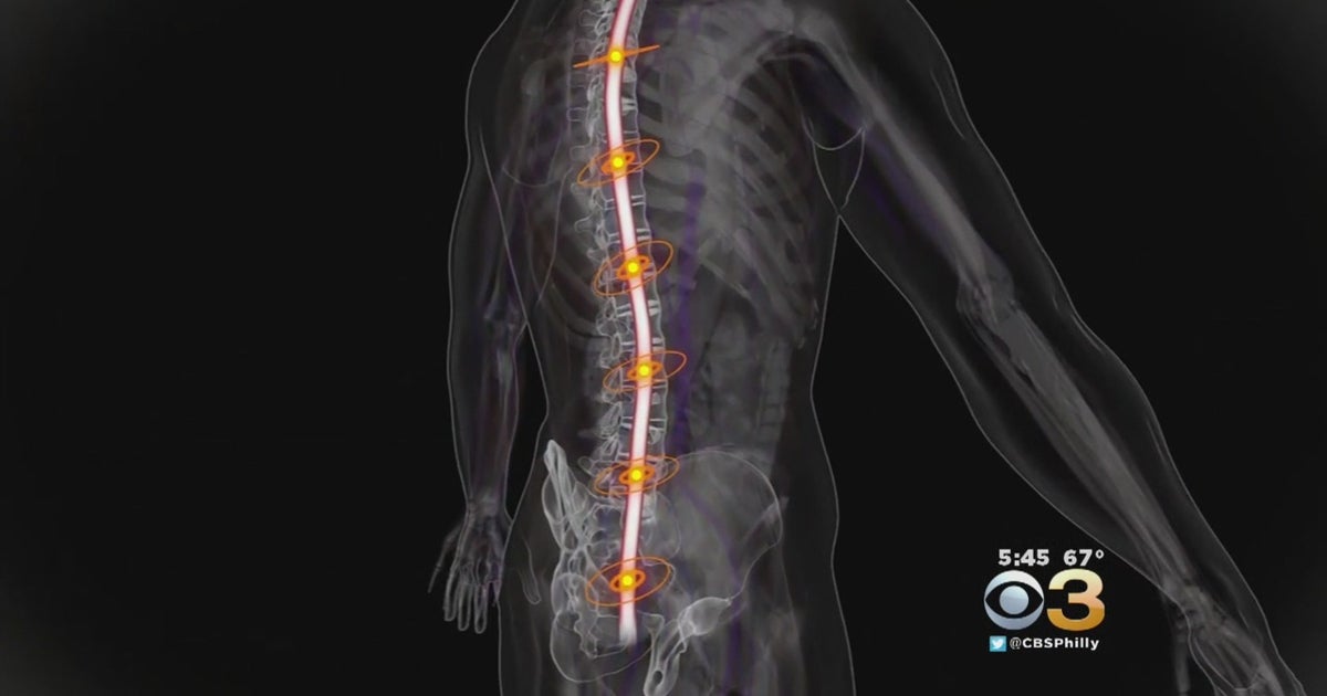 New Spinal Implant Helps Paralyzed Patients Walk Again - CBS Philadelphia