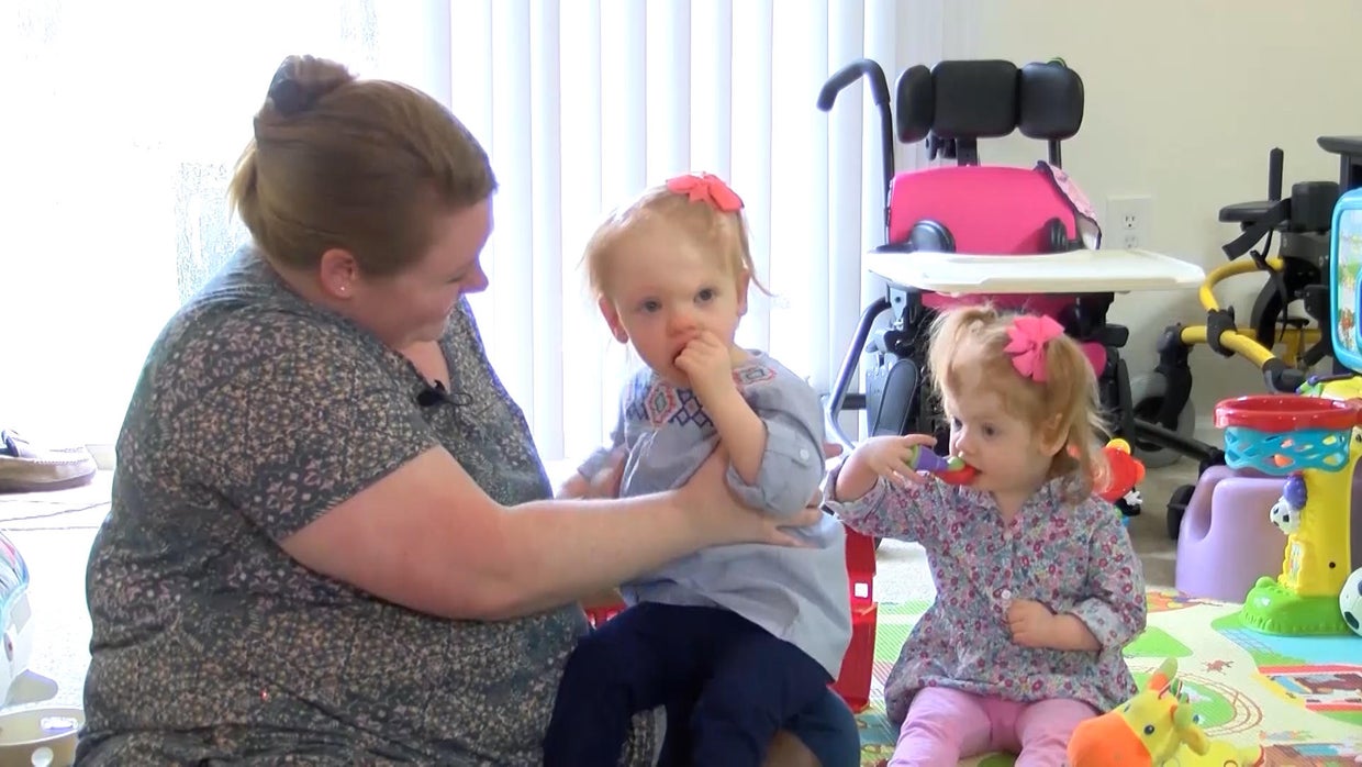 Formerly conjoined twins thriving after rare, complex surgery separated ...