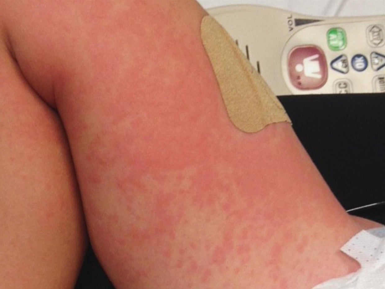 An end to food allergies? A possible answer to severe reactions to ...