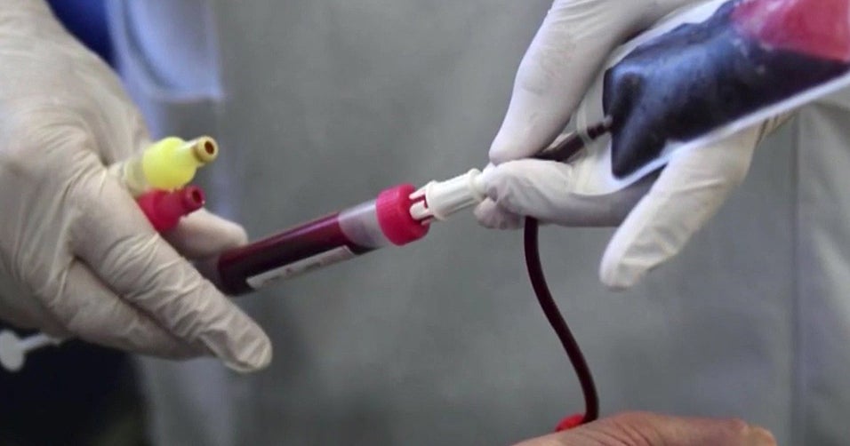 FDA Issues Warning Against 'Vampire Treatments' - CBS Los Angeles