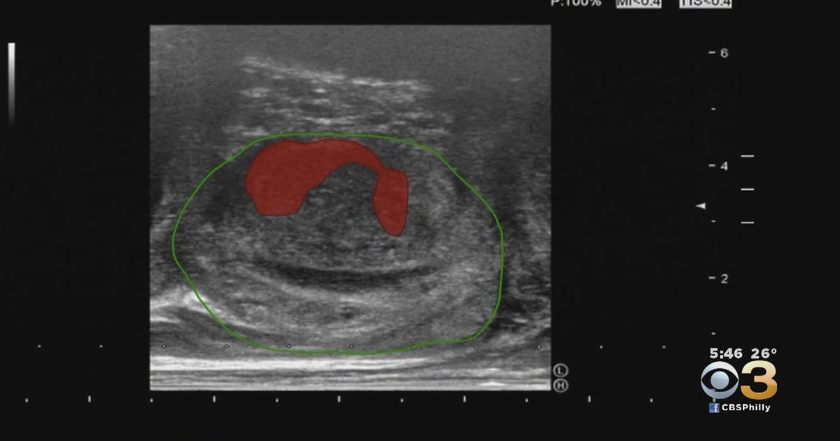 New Technology Improving Prostate Cancer Survival Rates With Earlier ...