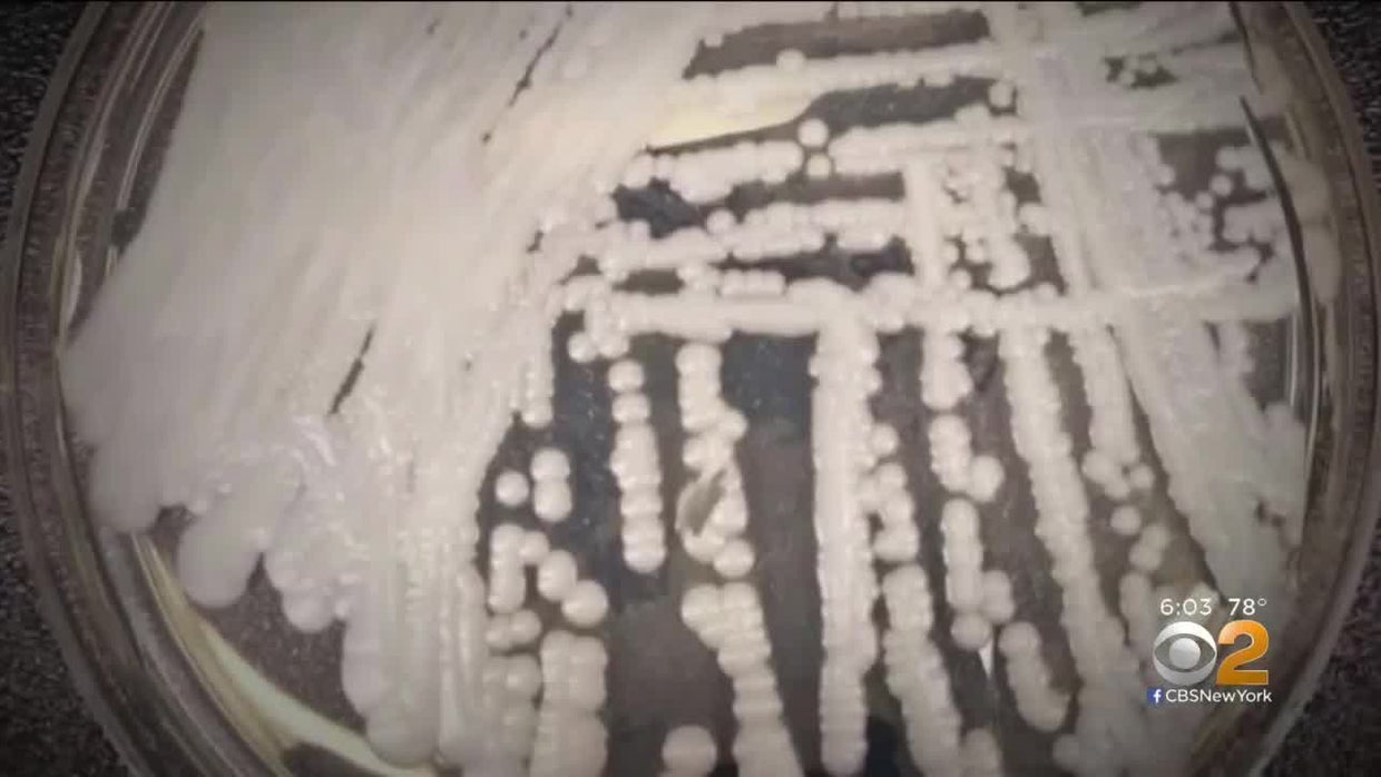 Superbug Fungus Sickens More Than 300 In New York State - CBS New York