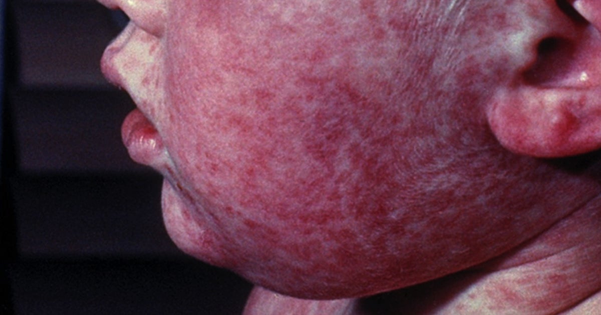 What You Need To Know To Protect Your Family Against The Measles - CBS ...
