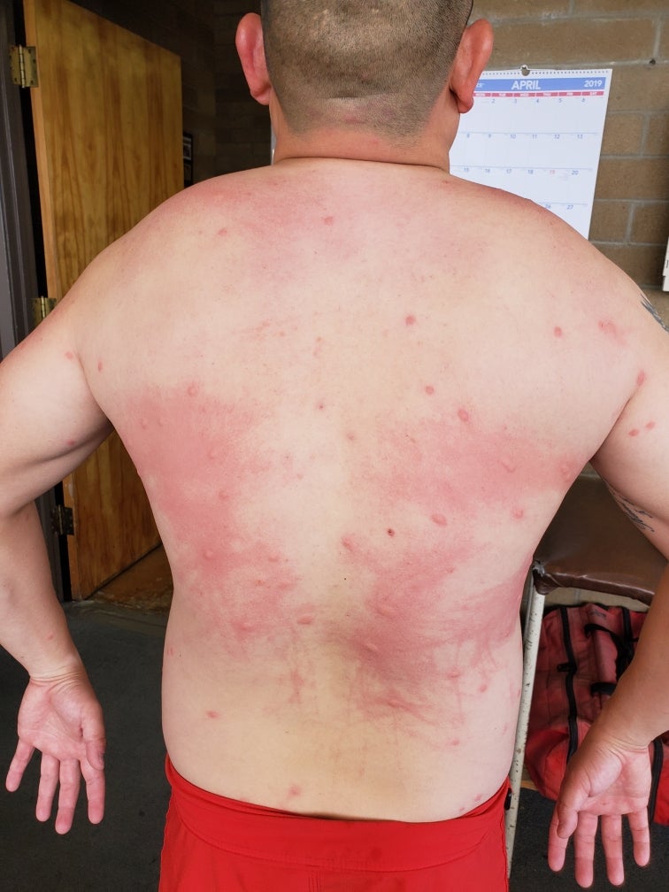 Over 20 Lifeguards Develop Rashes After Swimming In Hansen Dam Lake ...