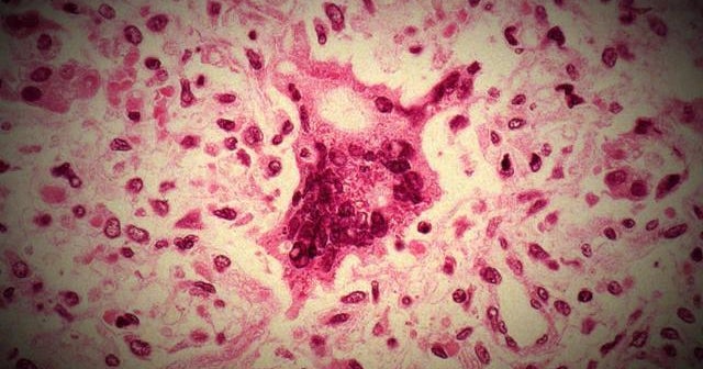 Measles outbreak: What you need to know before flying - CBS News