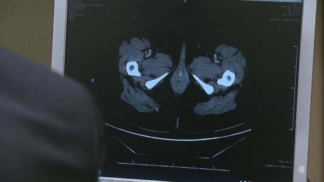22-Year-Old Battling Ovarian Cancer Wants Others To Know Subtle ...