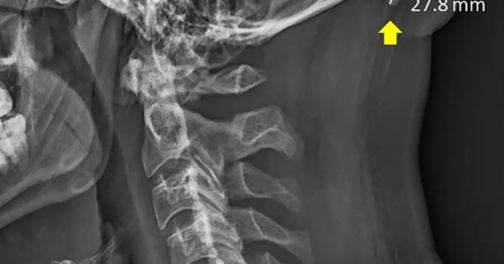 Researchers Link Smartphones To Bizarre Horn-Like Bumps On Young People ...