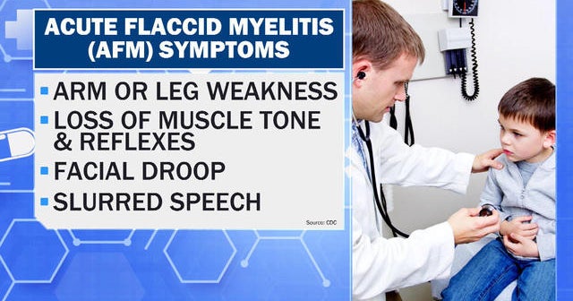 Polio-like illness AFM still "a little bit of a mystery" to researchers ...