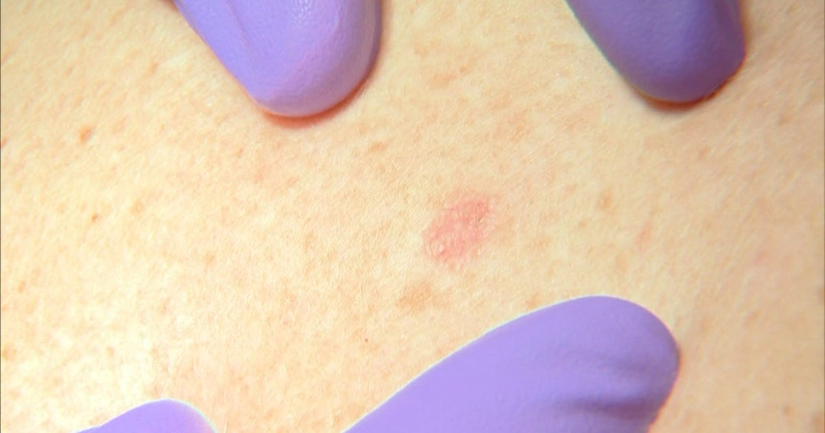 Most Americans Unaware Of Second Most Common Cancer In Nation, Survey ...