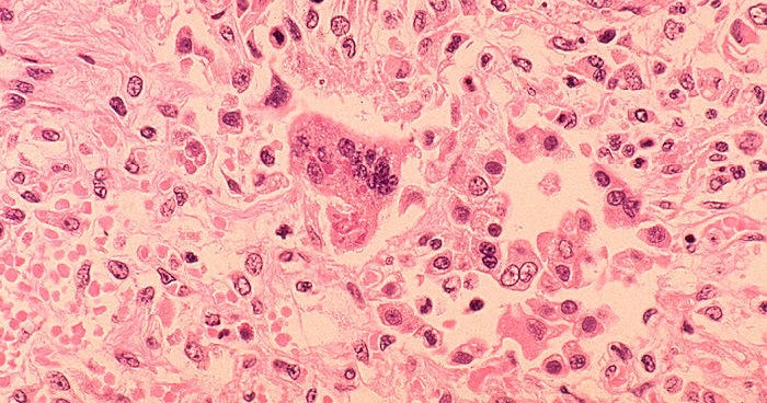 Samoa measles outbreak: Death toll climbs in monthlong measles outbreak ...