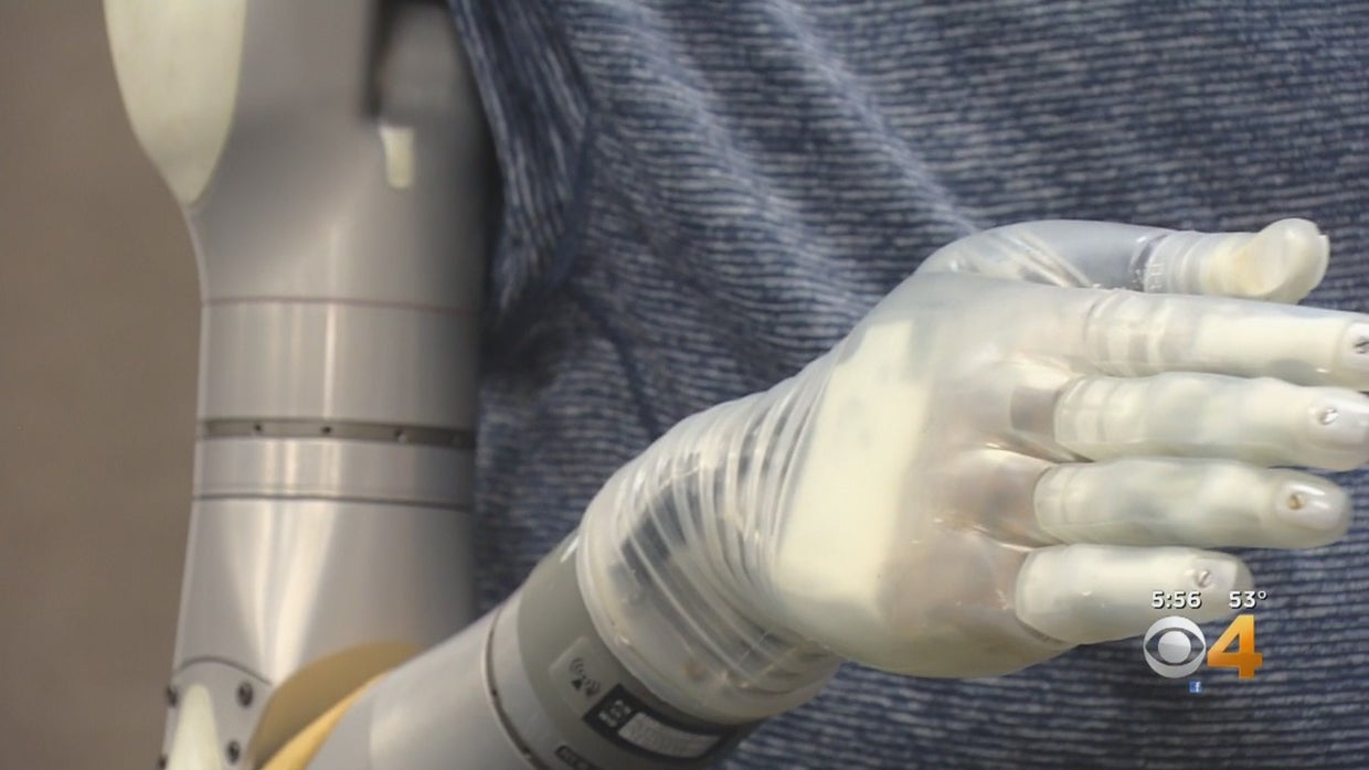 Prosthetic Technology: Denver Company Presents Advanced Bionic Arm ...