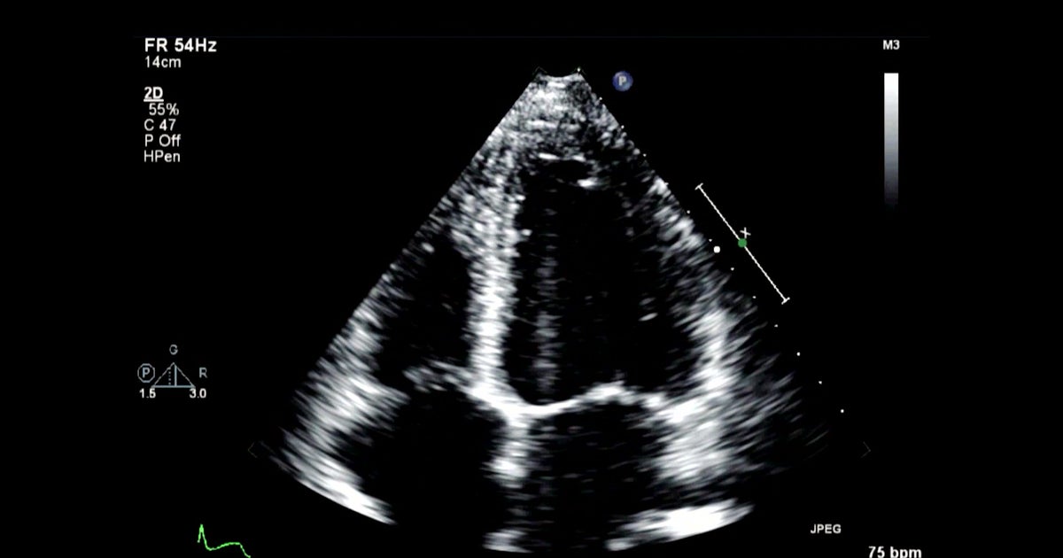 Emerging Cardio-Oncology Field Targets Heart Disease Risks In Cancer ...
