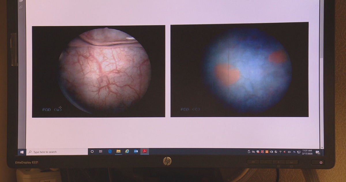 New Technology Sheds Light On Bladder Cancer - CBS Colorado