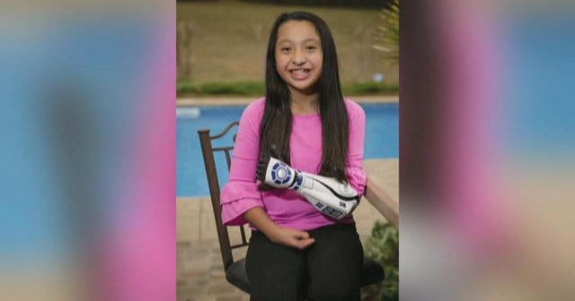 "Star Wars" fan gets bionic arm like Luke Skywalker - CBS News