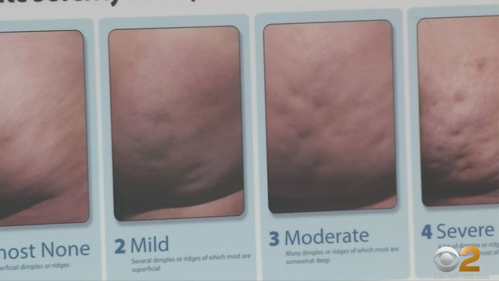FDA Approves QWO Enzyme Injection That Dissolves Cellulite - CBS New York