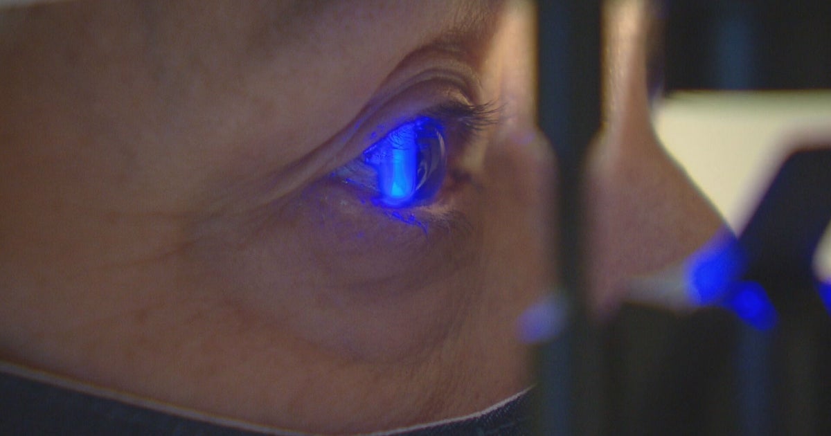Going Dropless After Cataract Surgery Thrills Patients - CBS Colorado
