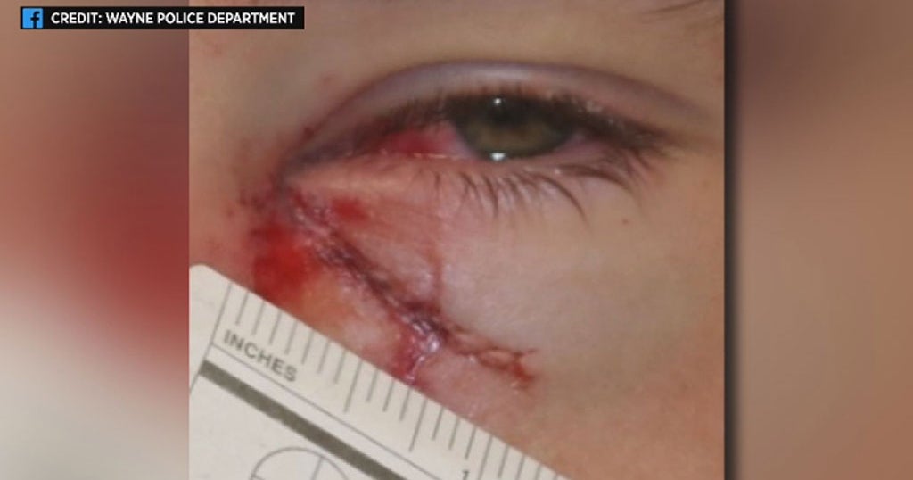 New Jersey Teen Suffers Eye Injury In Drive-By Paintball Shooting - CBS ...