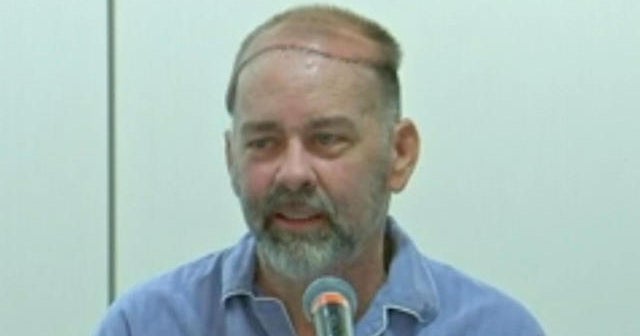 Texas doctors perform the world's first partial skull and scalp ...