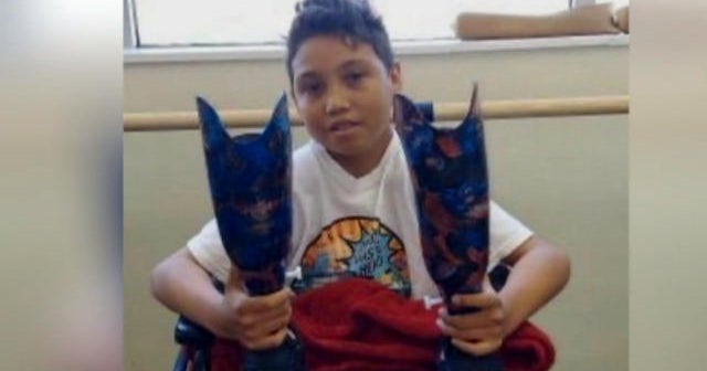 Artist transforms kids’ prosthetics into art - CBS News