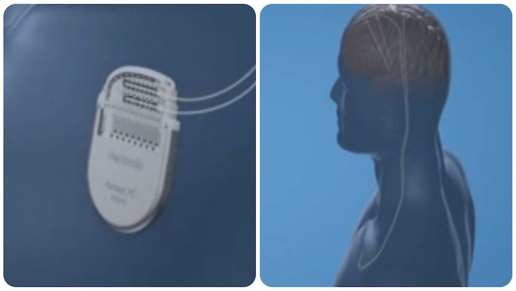 Deep Brain Stimulation Surgery Through Beth Israel Changes Parkinson's ...
