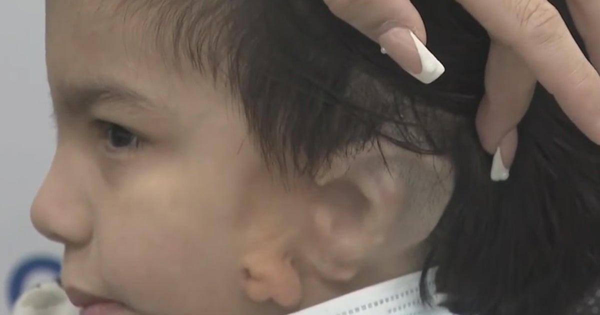 First-of-its-kind surgery uses cadaver tissue to create new ear for ...
