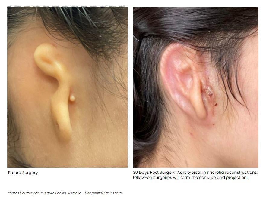 Woman gets 3D printed ear transplant made of her own cells - CBS News