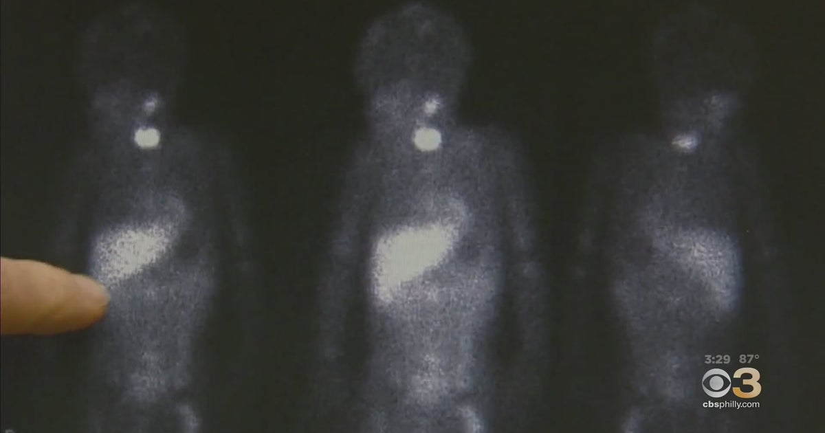 CHOP Doctor, Team Develop Drug That's Cured Children Of Often Deadly ...