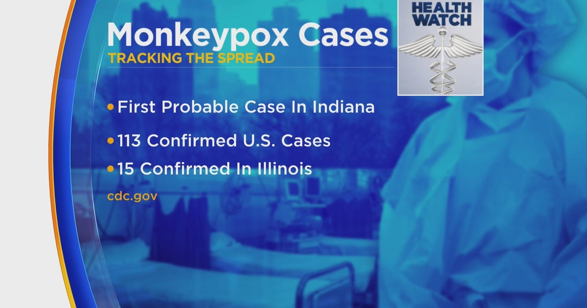 First probable case of monkeypox reported in Indiana - CBS Chicago
