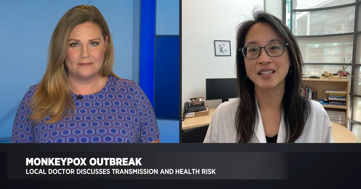 Local doctor discusses monkeypox outbreak - CBS San Francisco