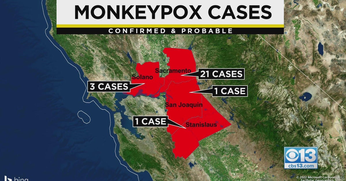 San Joaquin County Reports 1st Case Of Monkeypox - CBS Sacramento