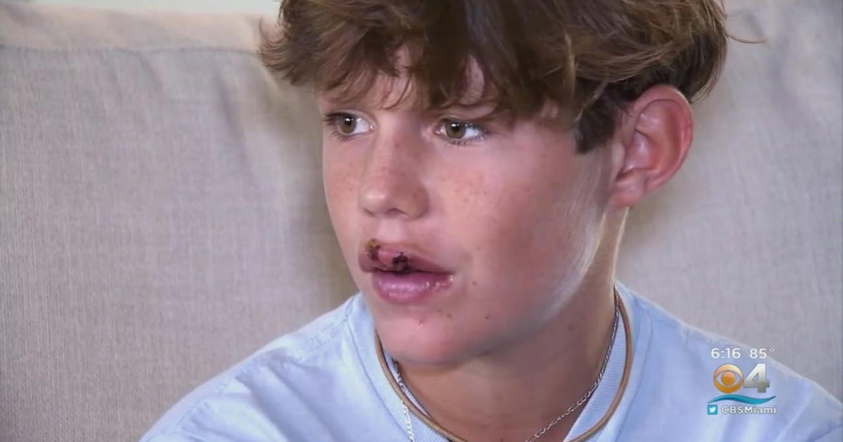 Florida teen shares his story on shark attack experience - CBS Miami