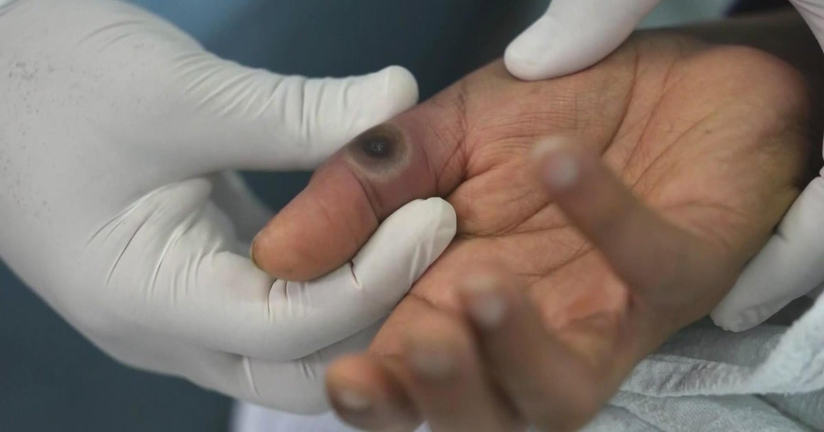 Cautious optimism as new monkeypox cases slow in Chicago - CBS Chicago