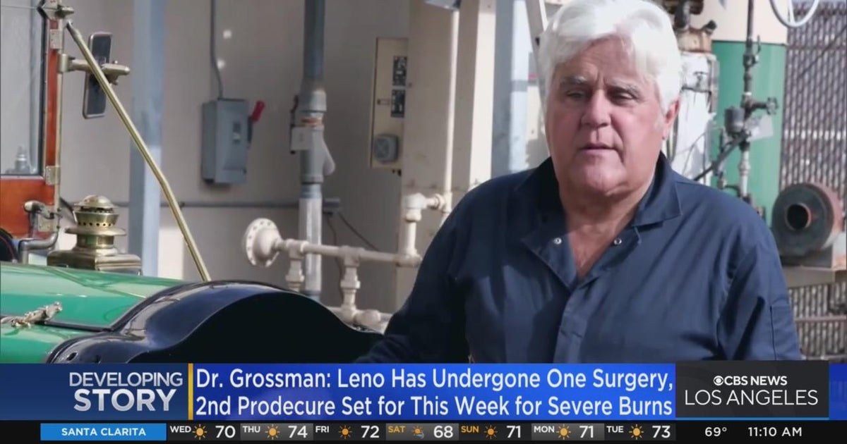 Jay Leno is expected to fully recover from burn injuries - CBS Los Angeles