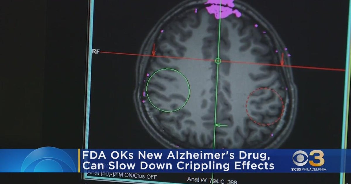 FDA OKs new Alzheimer's drug that can slow down crippling effects - CBS ...