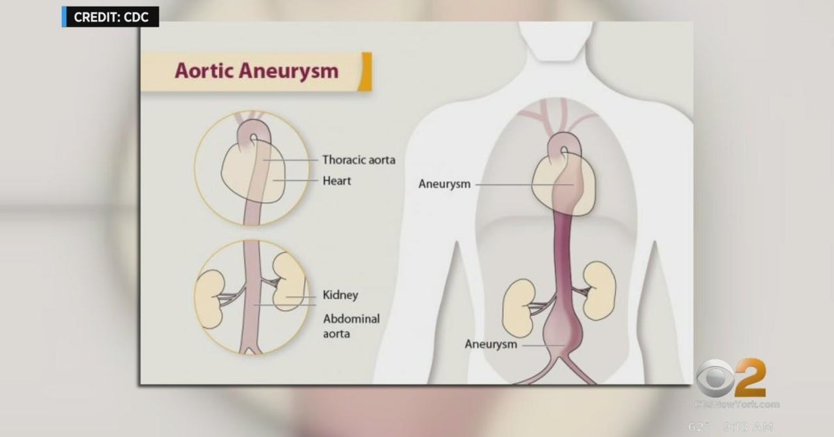 American Heart Month: Aortic aneurysms - CBS New York