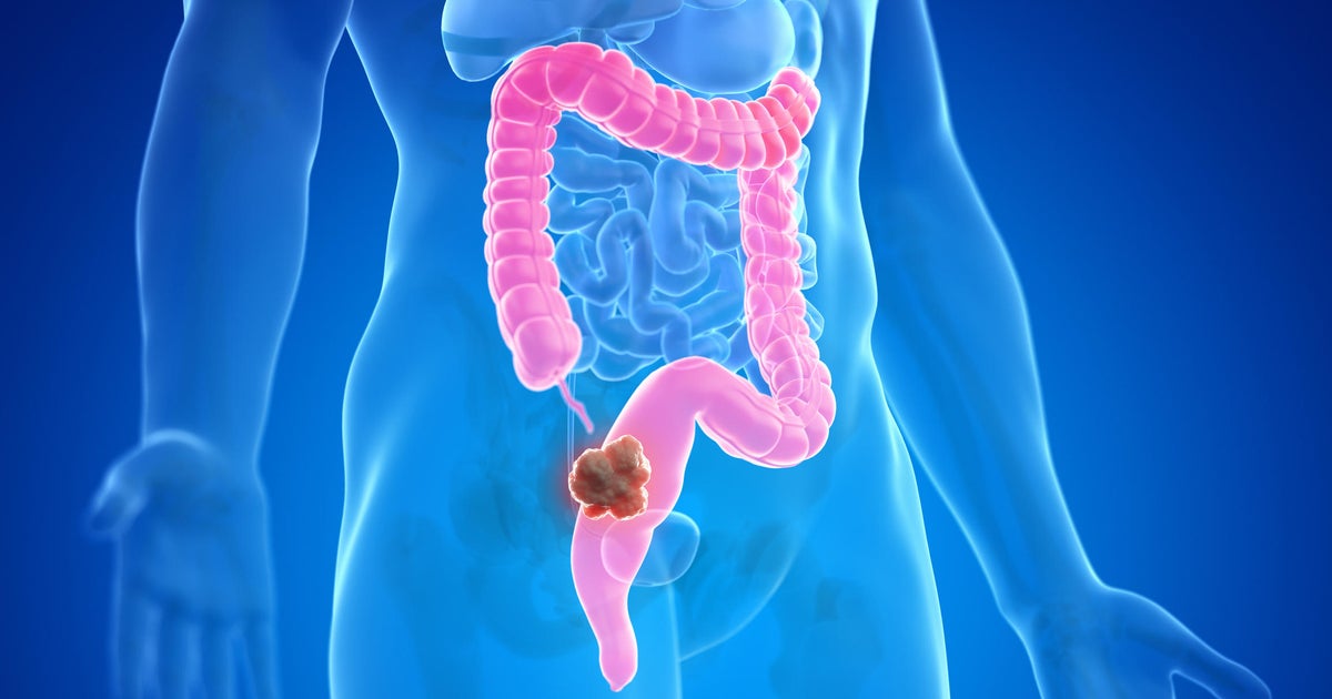 American Cancer Society: Colon cancer rates for younger people increase ...
