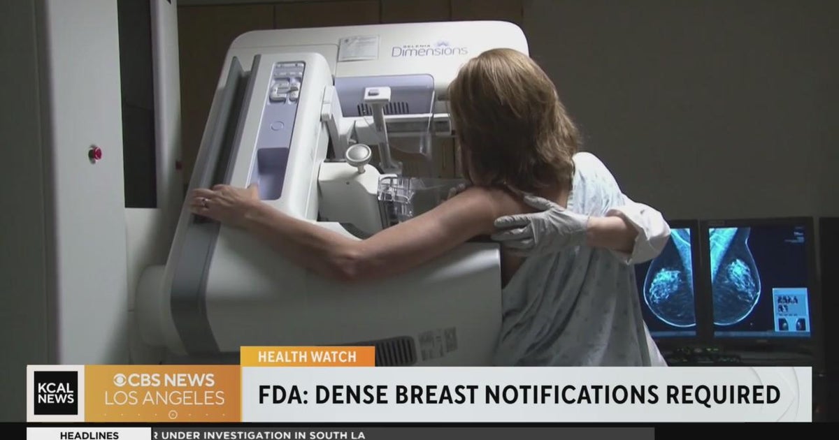 Health Watch New Fda Breast Density Mammography Regulations Cbs Los