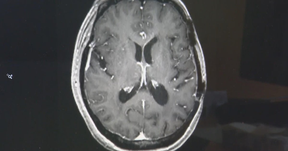 Clinical trial has promising results to fight brain cancer - CBS ...