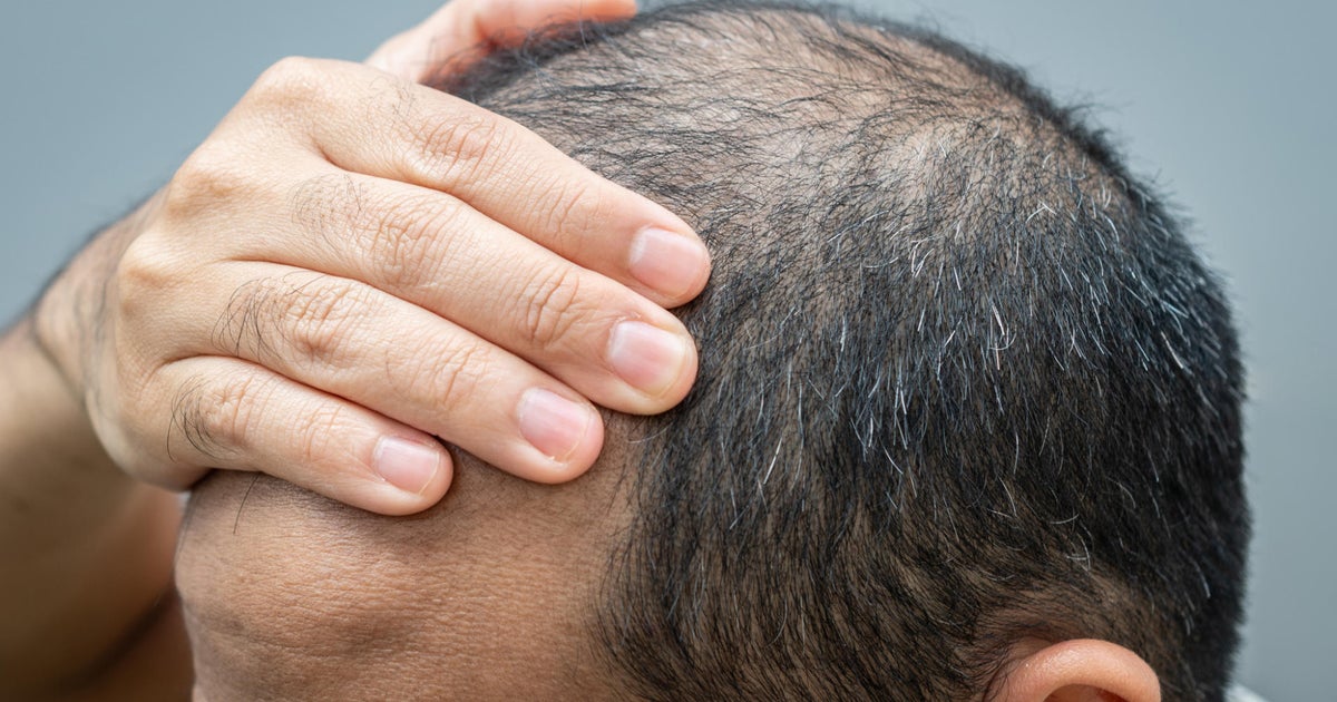 Experimental treatment for hair loss showing promise in mice - CBS Boston