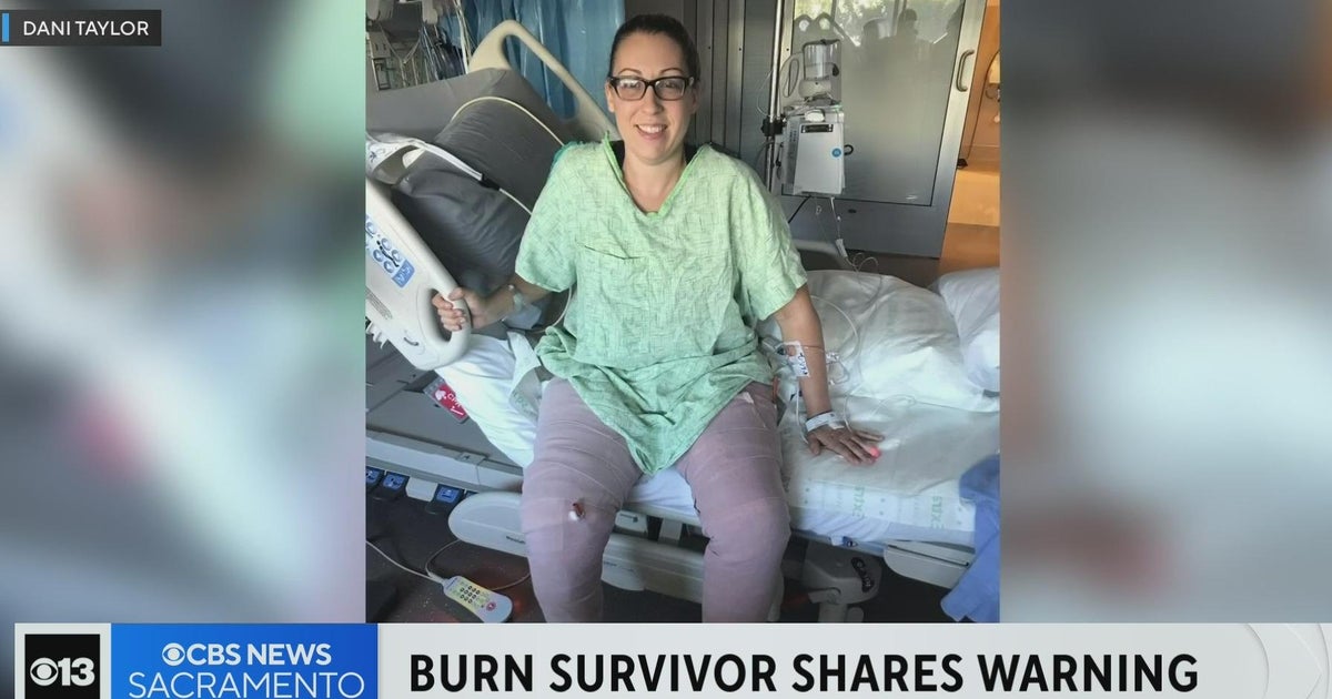Campfire-burn victim shares her story and warning - CBS Sacramento Campfire-burn victim shares her story and warning - CBS Sacramento