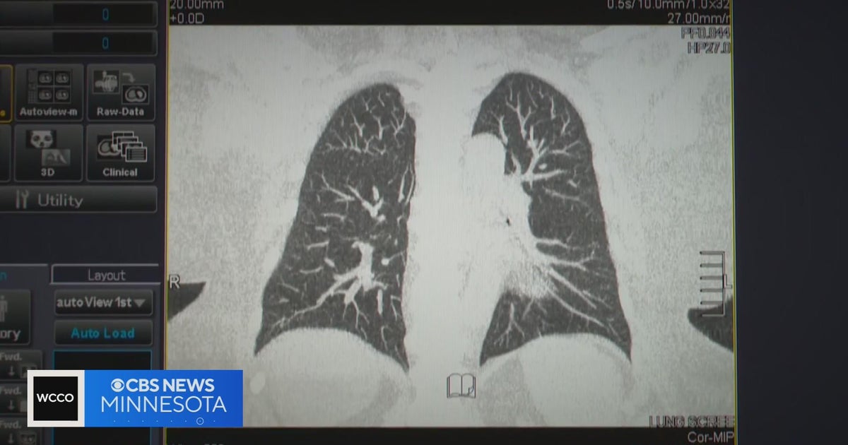 American Cancer Society updates lung cancer screening guidelines - CBS ...