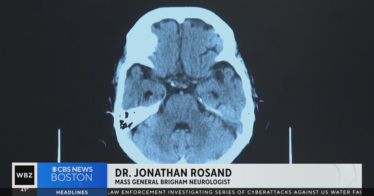 New "brain care score" from MGH can test your risk for dementia, stroke ...