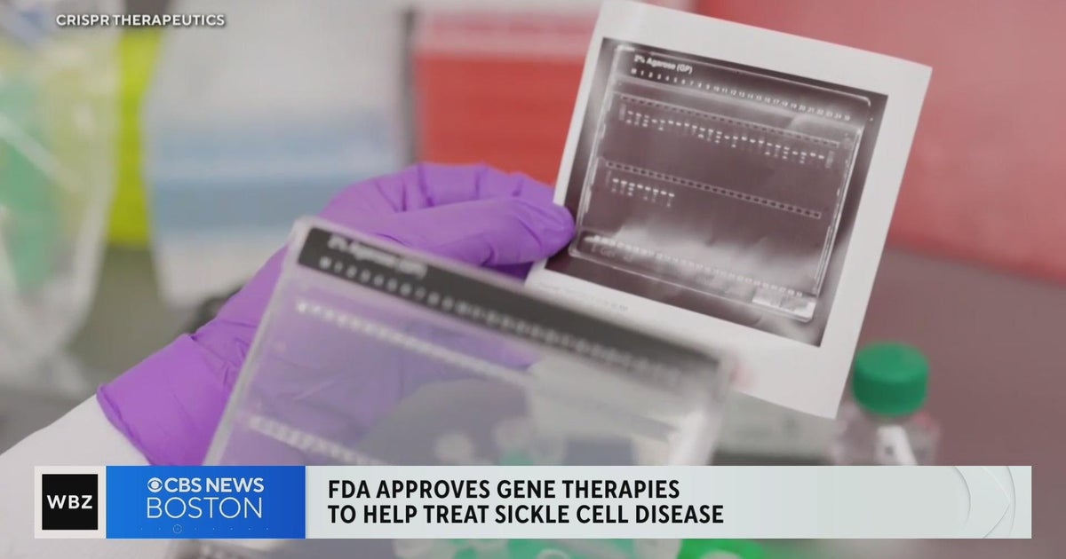 FDA approves gene-editing treatment developed by Boston company for sickle cell disease - CBS Boston