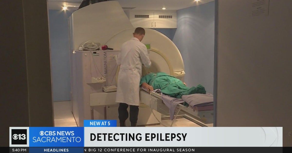 New epilepsy monitoring unit at UC Davis to help diagnose and treat ...