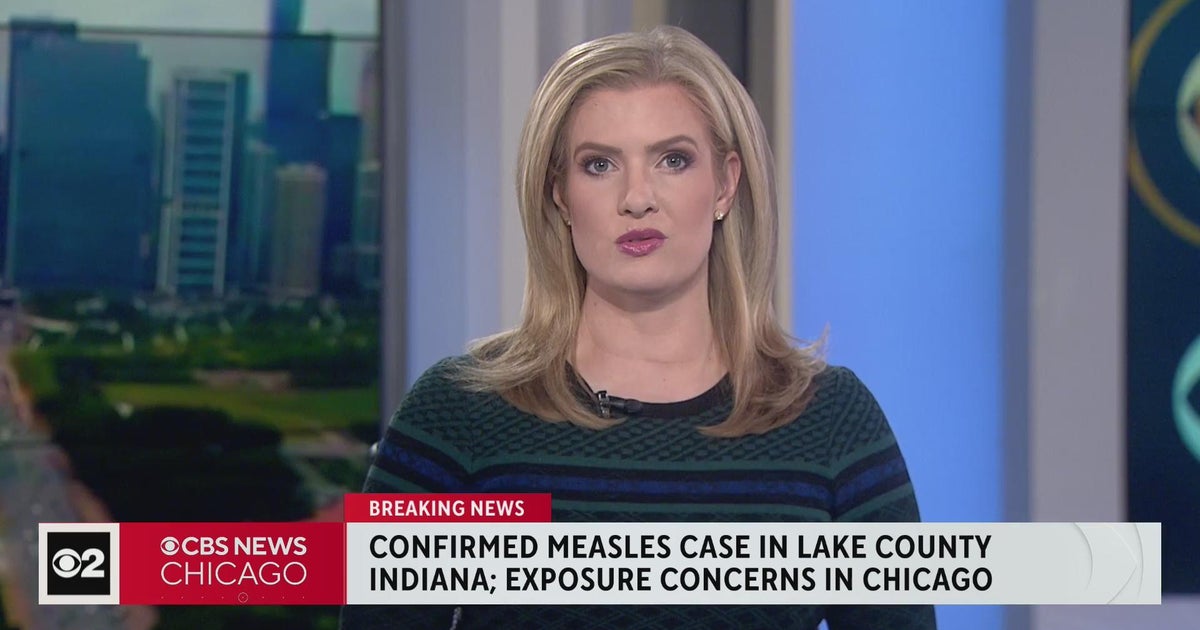 Case of measles confirmed in Northwest Indiana, first in state since ...