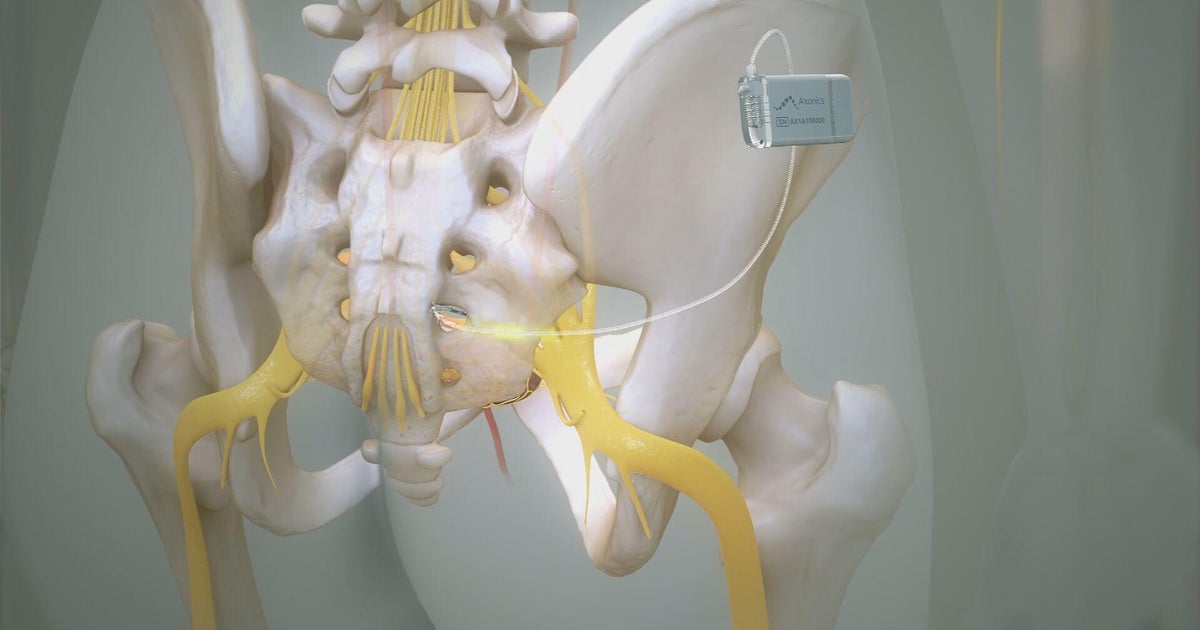 "Pacemaker"-like device helping women who suffer bladder leakage - CBS ...