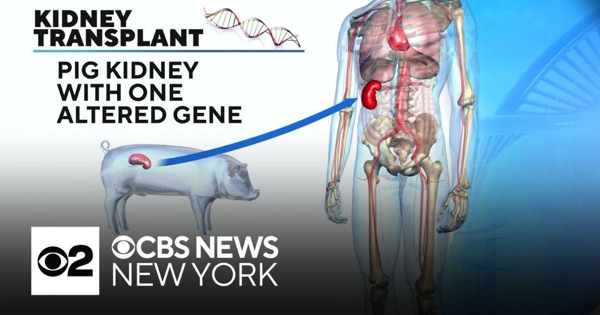N.J. woman receives pig's kidney in life-saving transplant - CBS New York